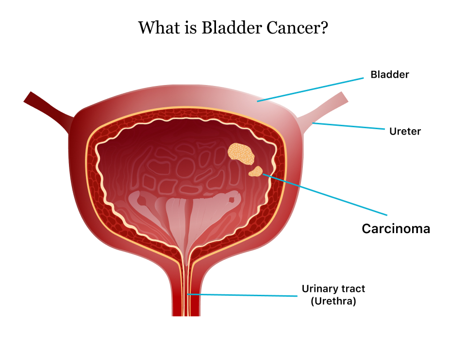 Comprehensive Bladder Cancer Guide Symptoms Treatments And Risks