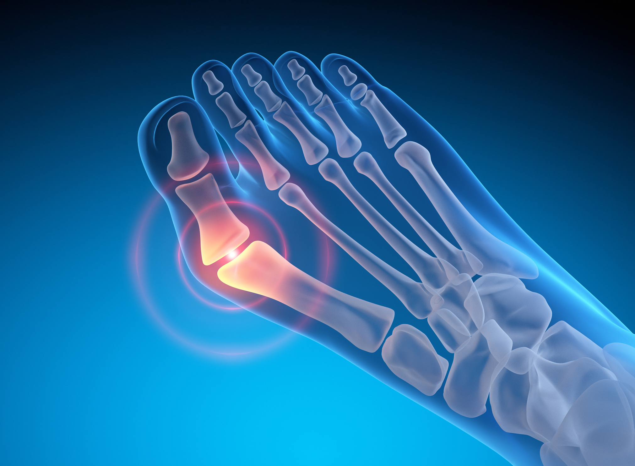 Cartiva Toe Implant: Risks, Recovery Time & Legal Concerns