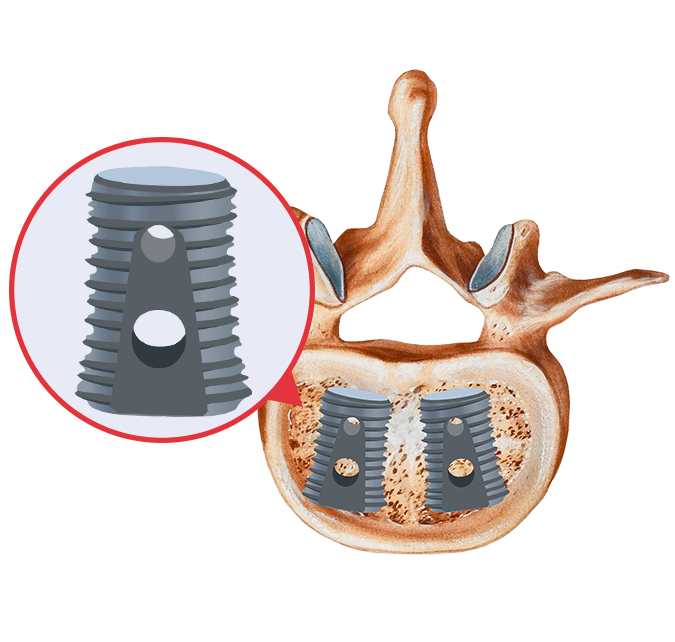 Infuse Bone Graft - Alternatives, Controversy & Complications