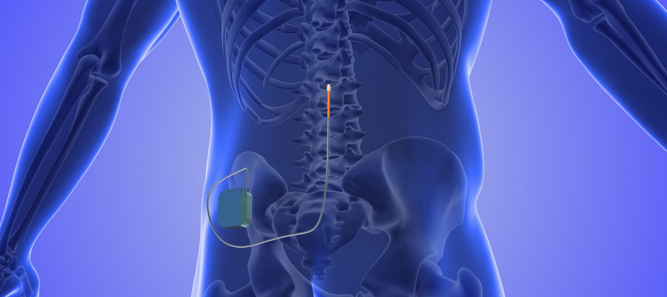 Spinal Cord Stimulator: Complications, Restrictions & Device Failures