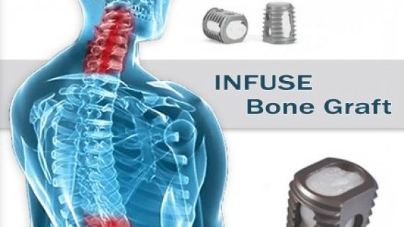 Infuse Bone Graft - Alternatives, Controversy & Complications