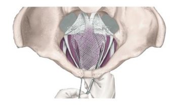 FDA Stops Sales of Transvaginal Mesh for Pelvic Organ Prolapse