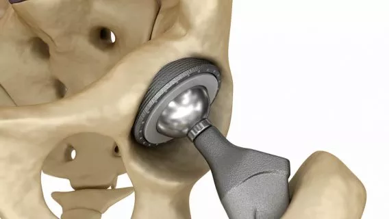 Hip Replacement - Procedure Types, Recovery Time, & Risks