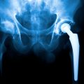 Metallosis | Symptoms & Causes of Hip Replacement Metallosis